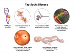 Finding a treatment for Tay-Sachs disease | The Stem Cellar